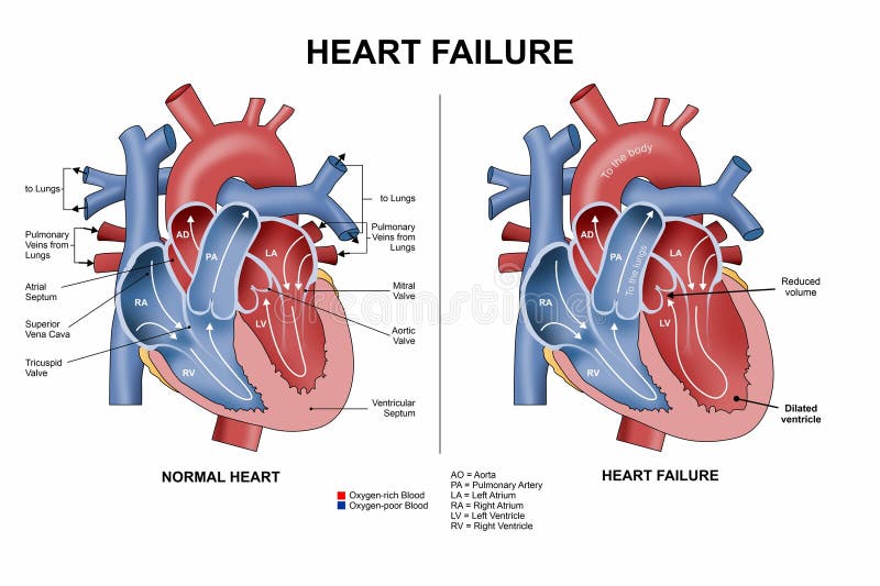 Heart Failure Cross Section of Heart Stock Illustration - Illustration ...