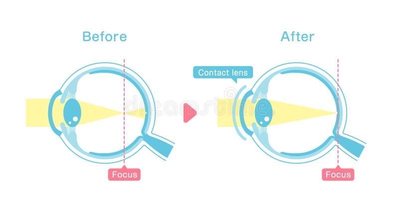 Illustration Comparing Vision before and after Wearing Contact Lens ...