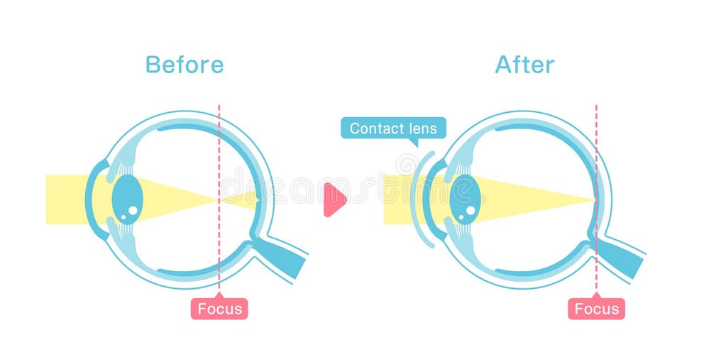 Illustration Comparing Vision before and after Wearing Contact Lens ...