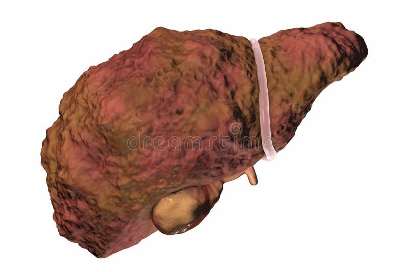 Illustration De Cirrhose Du Foie Illustration Stock - Illustration du ...