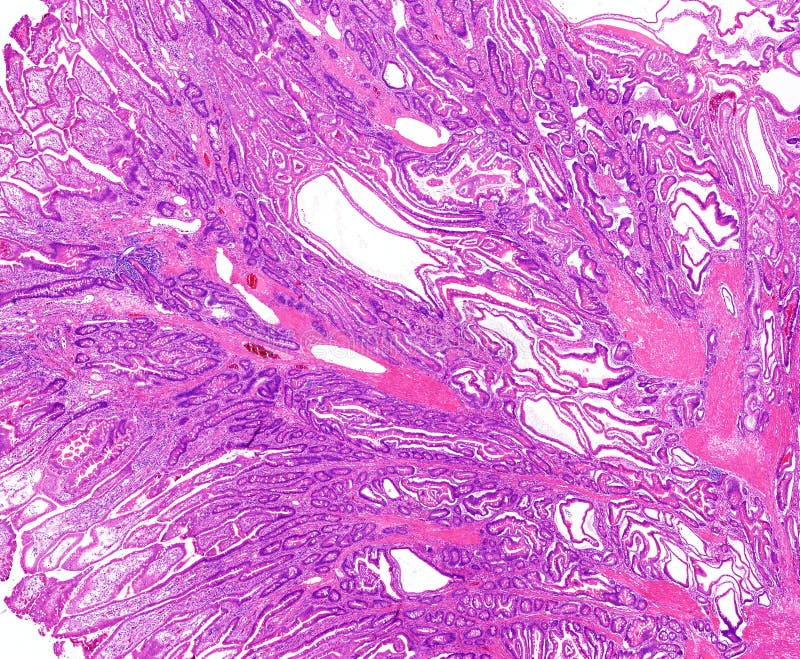 Illustration De Microscope De Polype Intestinal Image stock - Image du ...