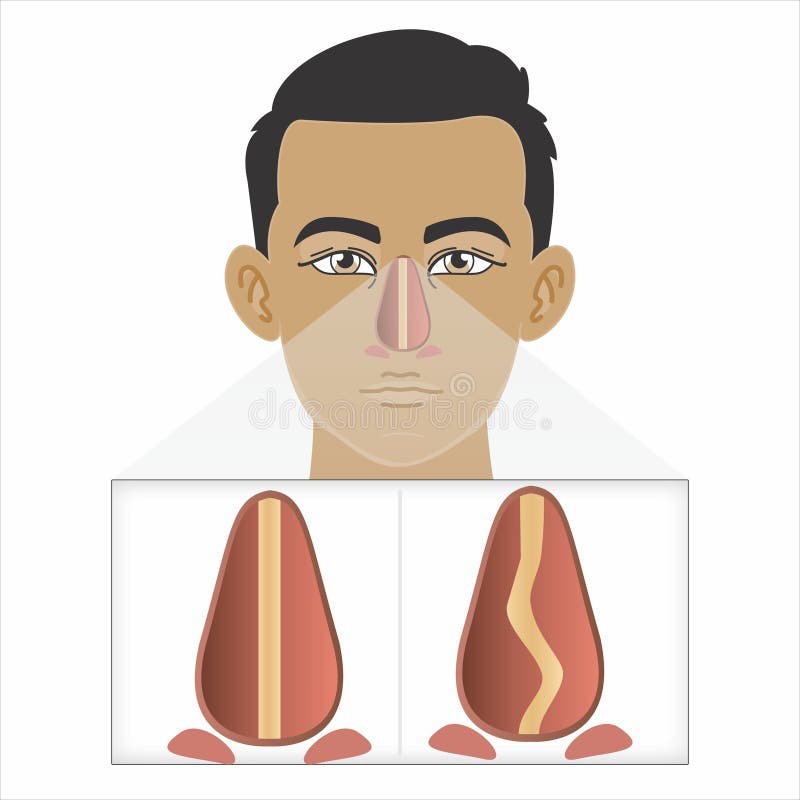 Broken Nose Stock Illustrations – 908 Broken Nose Stock Illustrations ...