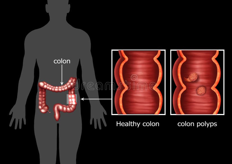 Illustration 3d Des Polypes De Deux Points Polype Dans L'intestin Blanc ...