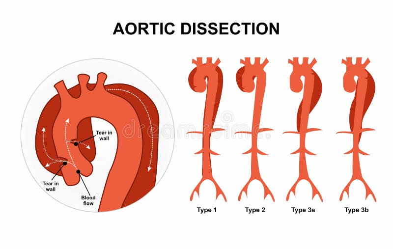 Aortic Dissection Illustration Stock Illustration - Illustration of ...