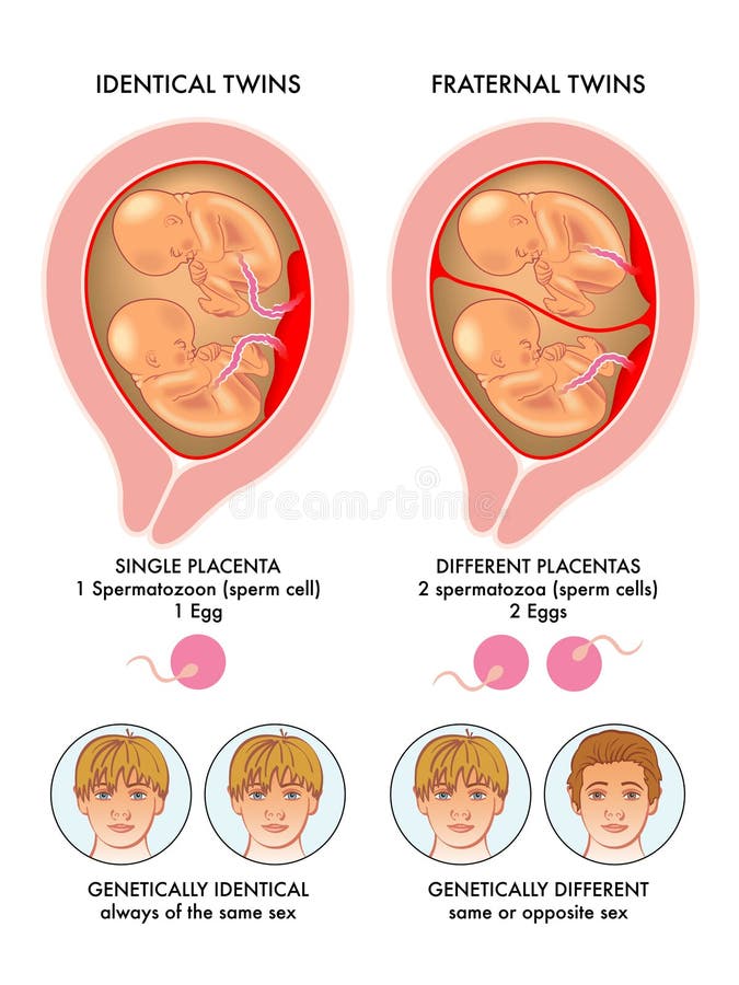 Identical and Fraternal Twins Stock Vector - Illustration of fraternal, identical: 402018738