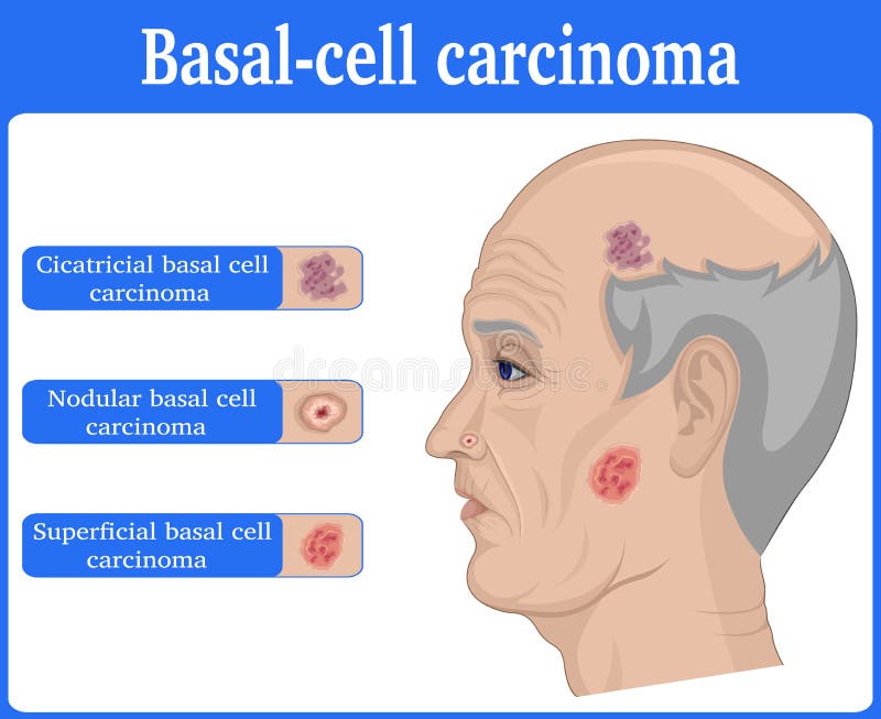 Illustration Du Carcinome De Cellule Basale Illustration de Vecteur ...