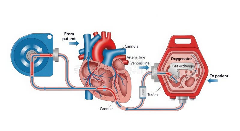 Extracorporeal Membrane Oxygenation Heart Lung Machine Diagram Stock ...