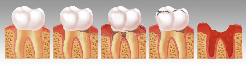 Illustration of the Process of Tooth Decay Stock Illustration ...