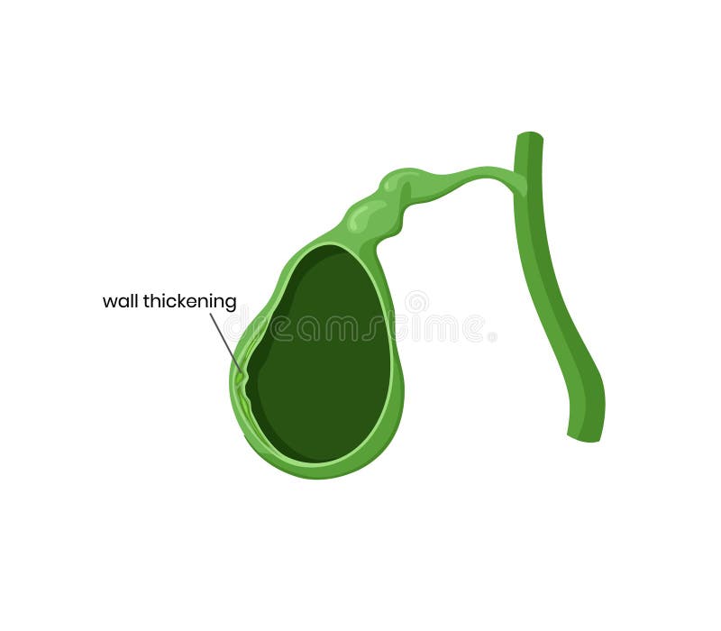 Illustration of the Gallbladder Wall Thickening. Vector Immage of the ...