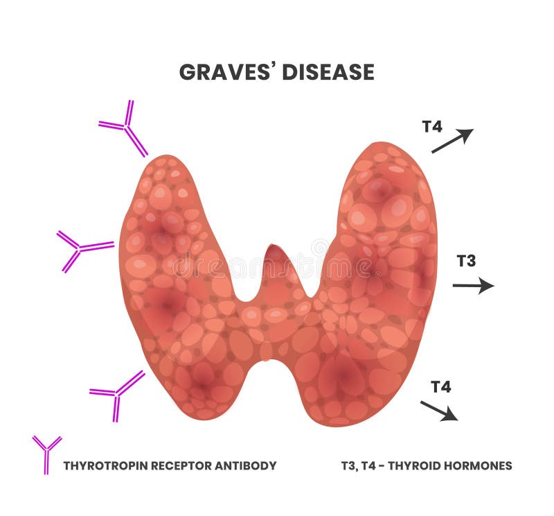 Graves Disease or Basedow Disease. Symptoms and Signs Stock Vector ...