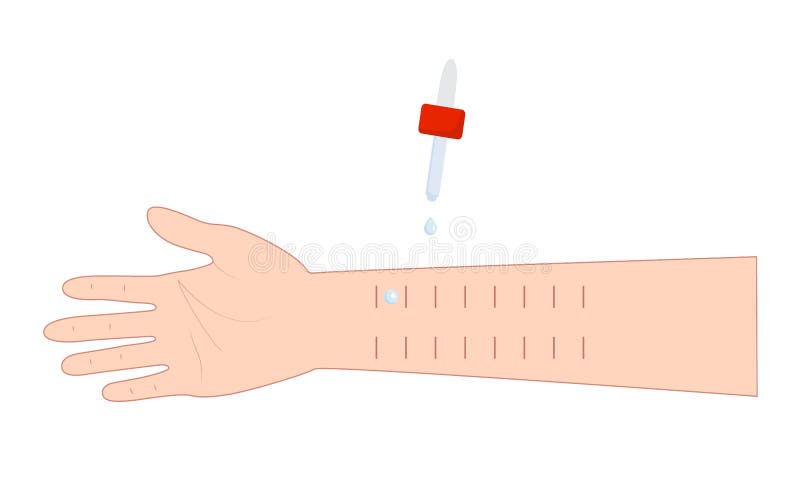 Illustration of a Hand with Skin Tests for Allergy Stock Vector ...