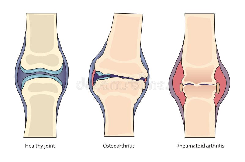 Illustration of Healthy Joint Vs Arthritis Comparison Stock Vector ...