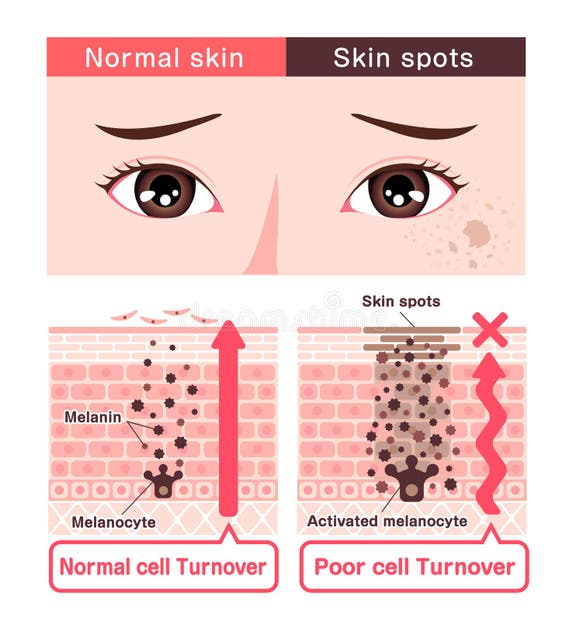 Illustration of How Skin Spots (hyperpigmentation) are Created Stock ...