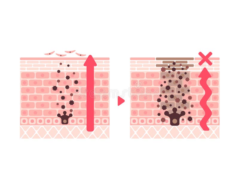 Illustration of How Skin Spots (hyperpigmentation) are Created Stock ...