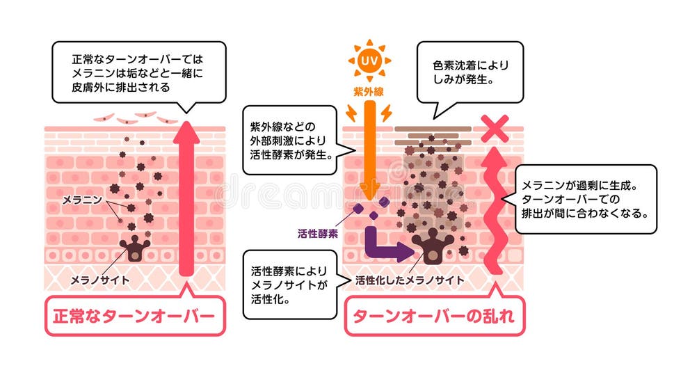 Illustration of How Skin Spots (hyperpigmentation) are Created Stock ...