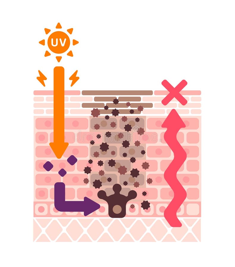 Illustration of How Skin Spots (hyperpigmentation) are Created Stock ...