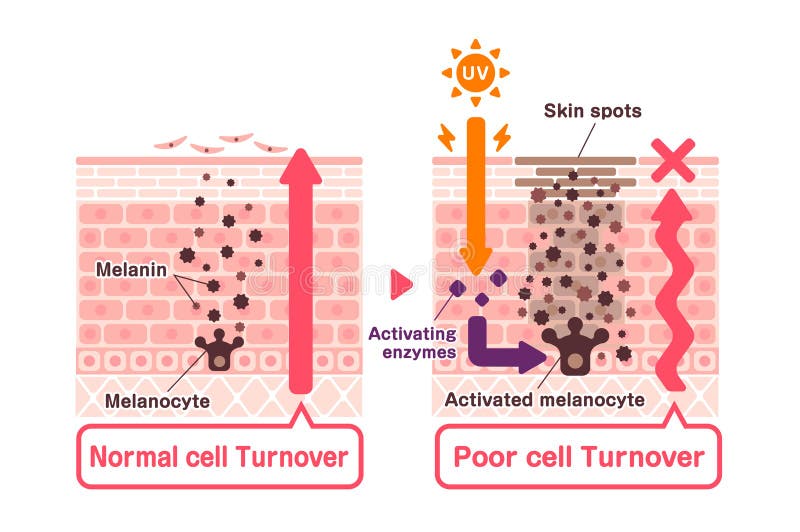 Illustration of How Skin Spots (hyperpigmentation) are Created Stock ...