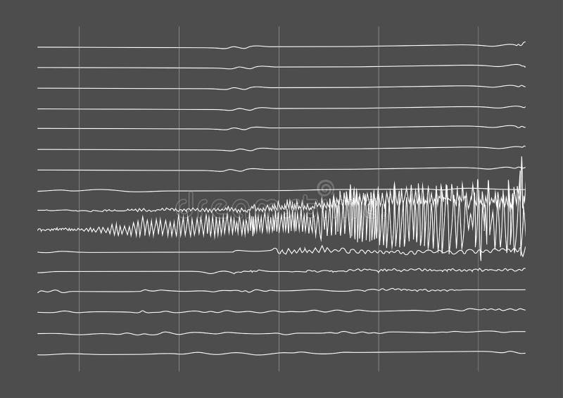 Illustration of Ictal EEG Recording during Seizure Stock Vector ... Illustration of Ictal EEG Recording during Seizure Stock Vector ...