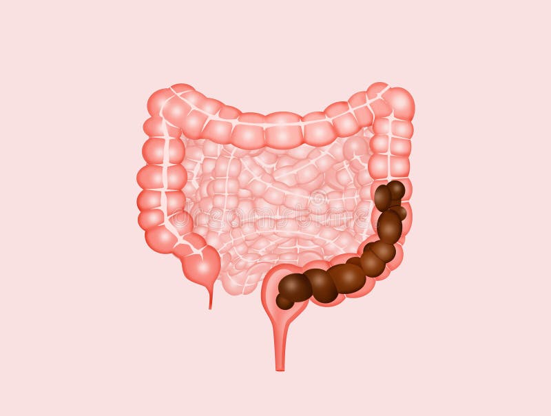 Illustration of the Intestine with Feces Stock Illustration ...