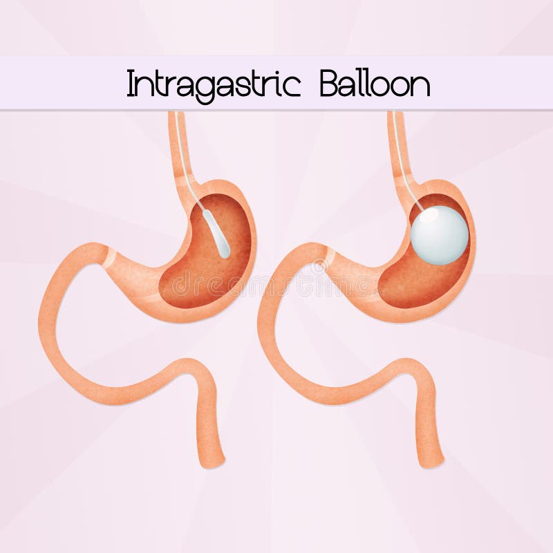 Illustration of Intragastric Balloon Stock Illustration - Illustration ...