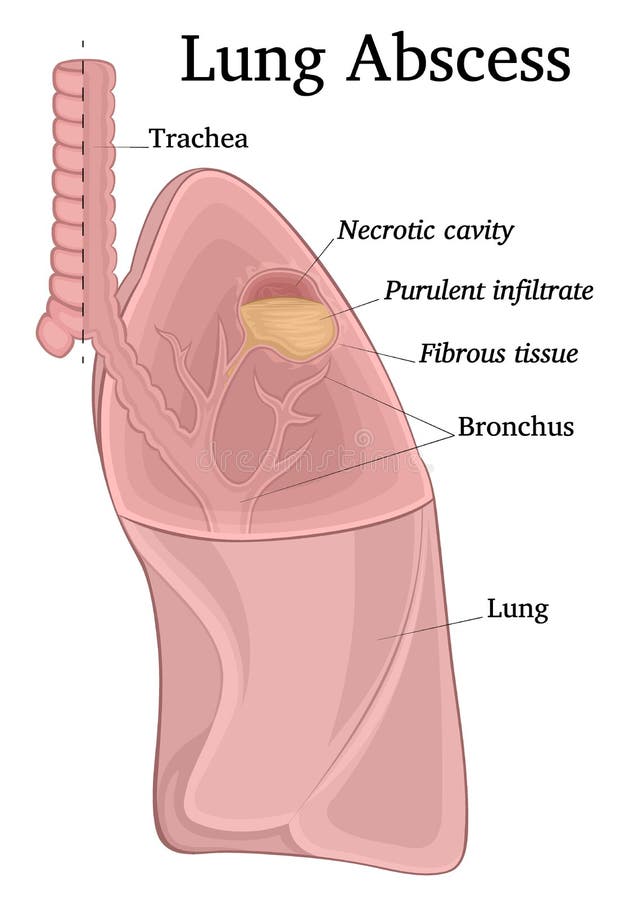 Illustration Of Lung Cancer Types Stock Vector Illustration Of