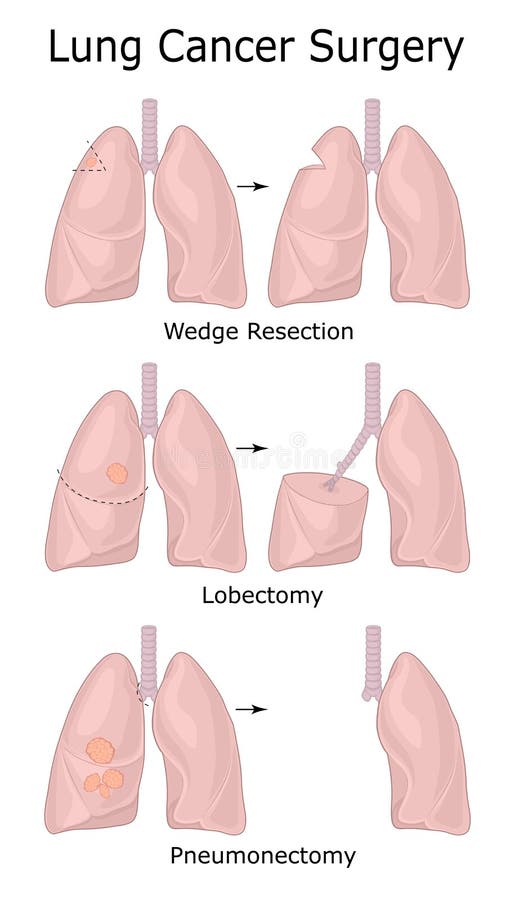 Wedge Resection Stock Illustrations – 7 Wedge Resection Stock ...