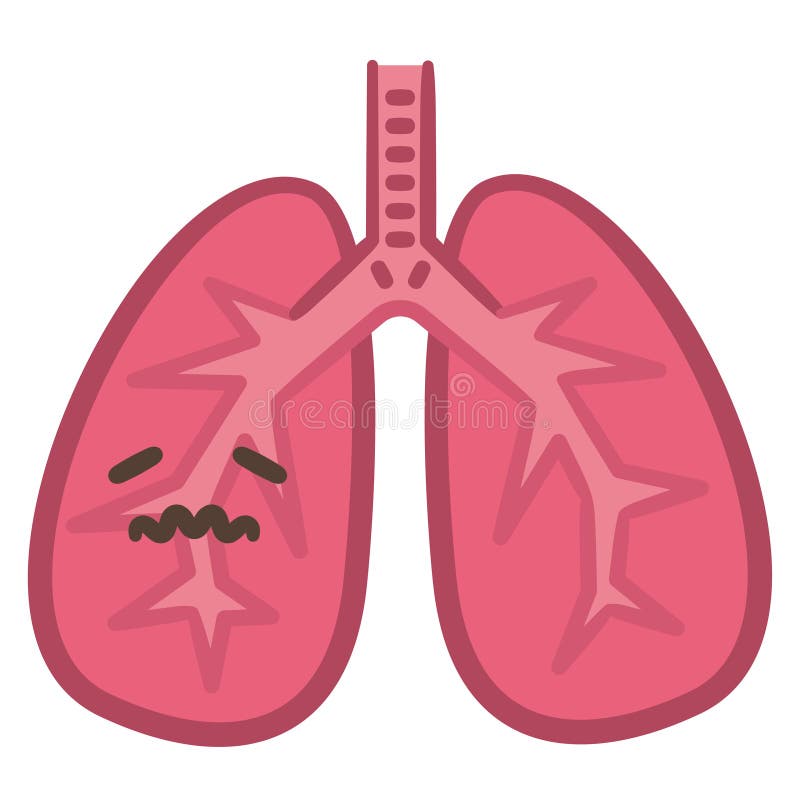 Lung Infection Pneumonia Medical Vector Illustration on White ...