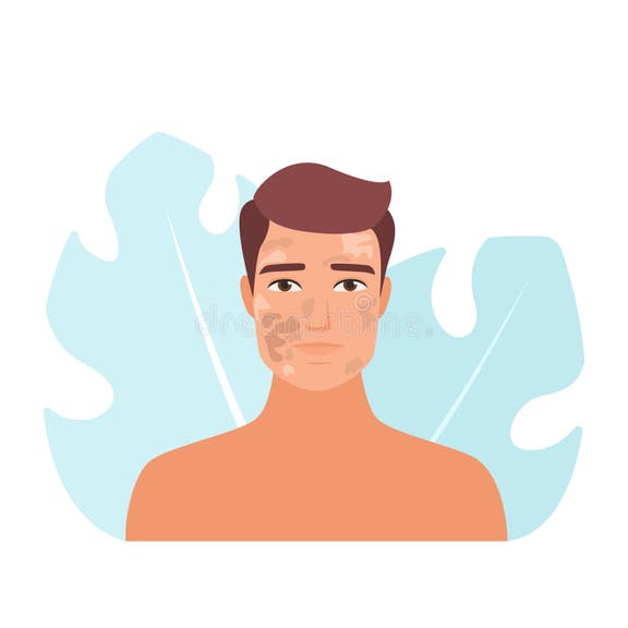 Man with Melasma and Hyperpigmentation Stock Vector - Illustration of ...