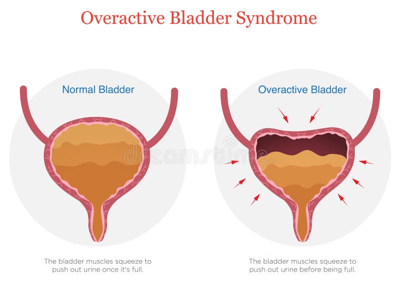 Bladder Problems Stock Illustrations – 338 Bladder Problems Stock ...