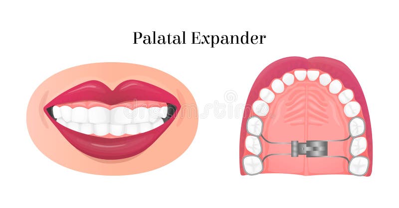 An Illustration with Palatal Expander, Bottom View Stock Vector ...