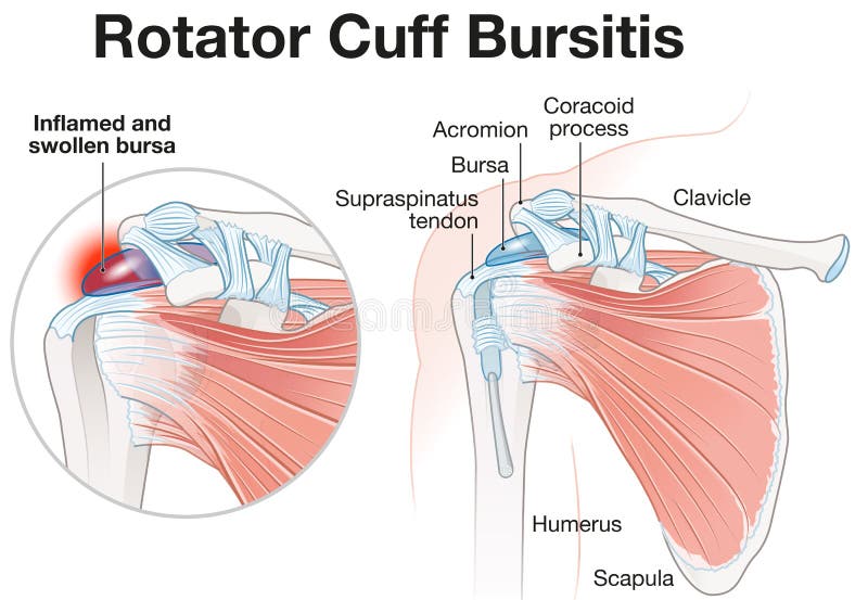 Rotator Cuff Bursitis Shoulder Illustration. Labeled Stock Illustration ...