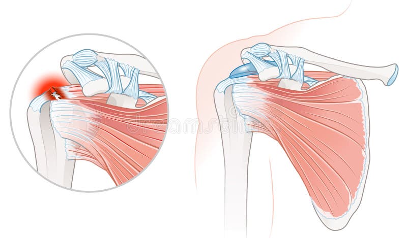Rotator Cuff Tear Shoulder Illustration Stock Illustration ...