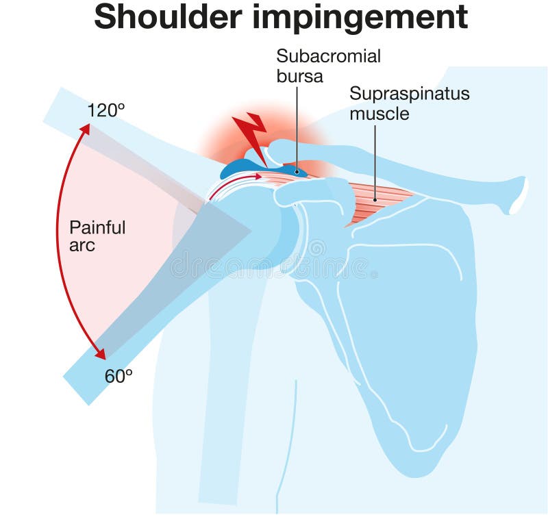 Shoulder Joint. Shoulder Impingement. Labeled Illustration Stock ...