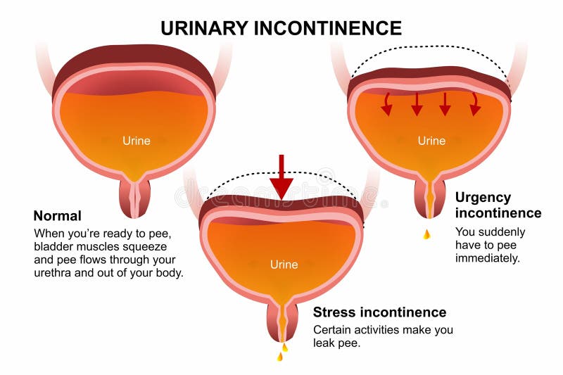 Urinary Incontinence Illustration Urine Stock Image - Illustration of ...