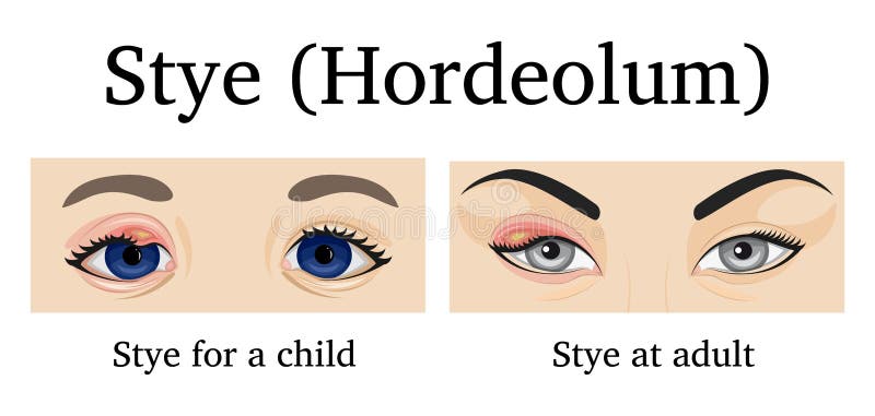 Stye on Eye stock vector. Illustration of disease, blue - 23649449
