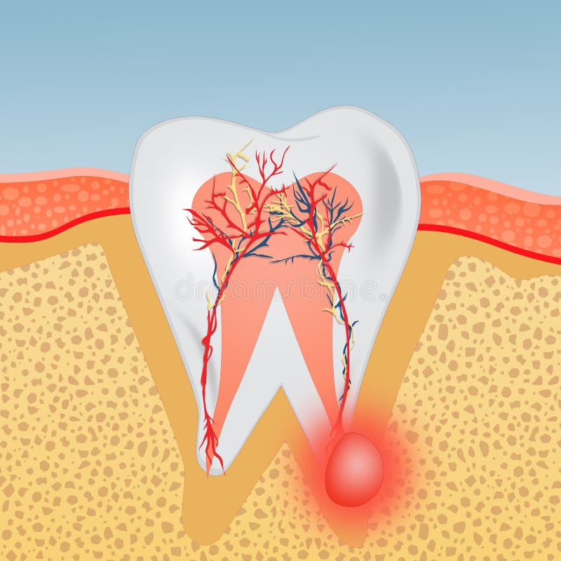 Abscess Tooth Vector Illustration. Labeled Medical Diagram with ...