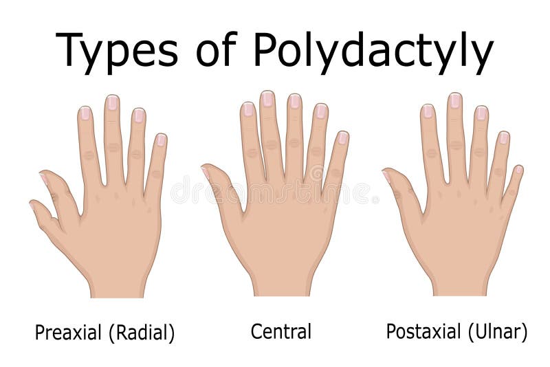 Illustration of Types of Polydactyly Stock Vector - Illustration of ...
