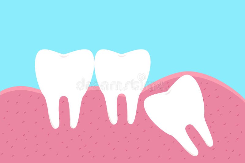 Illustration of Wisdom Tooth.Dental Concept Stock Illustration ...