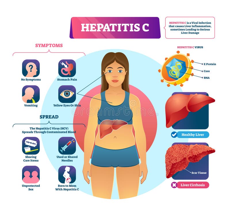Ilustração Do Vetor Da Hepatite C Esquema Etiquetado Da Explicação Da ... Ilustração Do Vetor Da Hepatite C Esquema Etiquetado Da Explicação Da ...