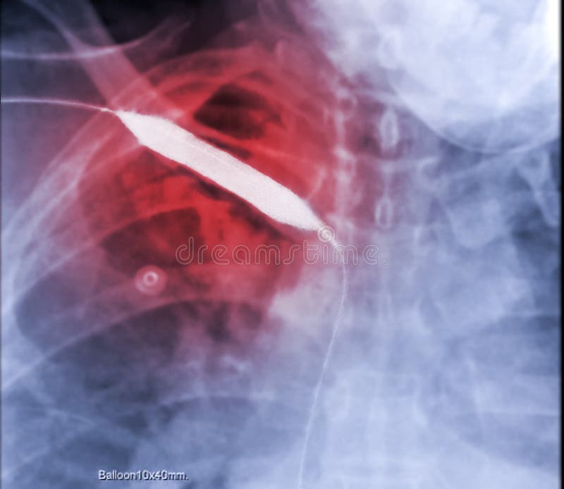 Image of Angioplasty, Balloon Angioplasty and Percutaneous Transluminal ...
