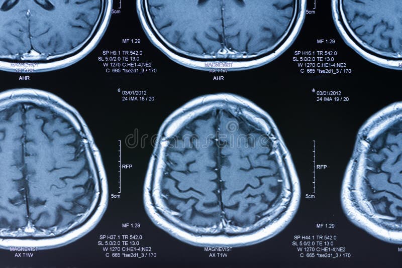 Brain CT Scan X-ray Film Image Brain Stock Image - Image of accident ...