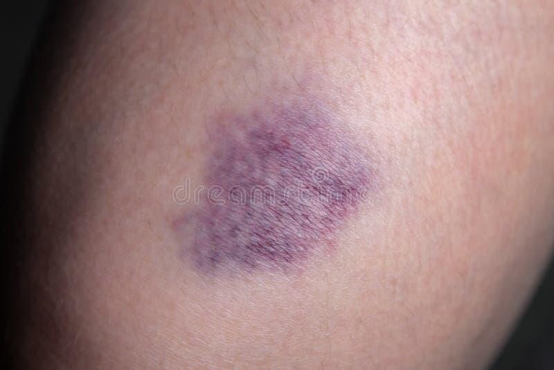 Image of the Bruise on Woman Leg Stock Photo - Image of health, woman ...