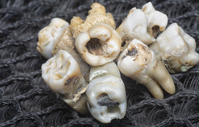 The Bundle of Unwanted Extracted Decay Human Teeth. Stock Photo - Image ...