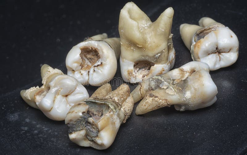 The Bundle of Unwanted Extracted Decay Human Teeth. Stock Image - Image ...