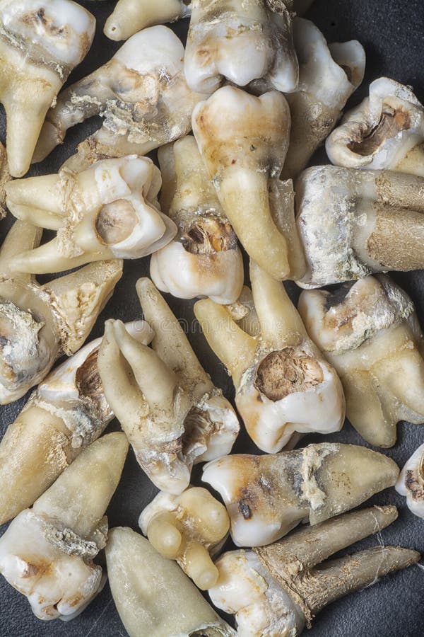 The Bundle of Unwanted Extracted Decay Human Teeth. Stock Photo - Image ...