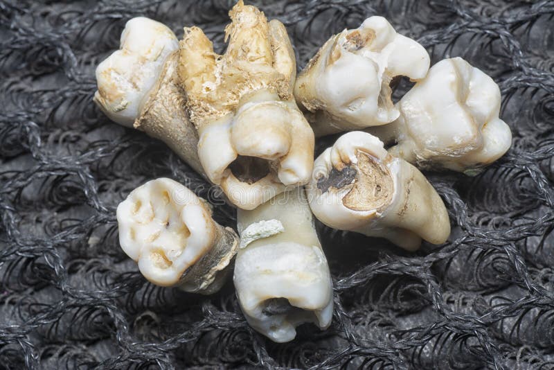 The Bundle of Unwanted Extracted Decay Human Teeth. Stock Photo - Image ...