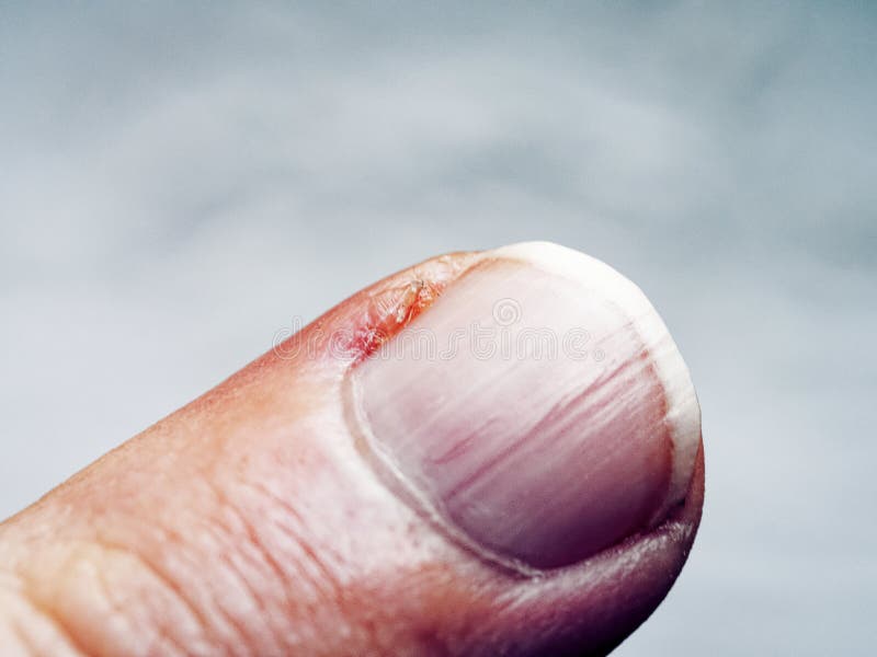 The Image Captures the Texture and Details of an Injured Finger Stock ...