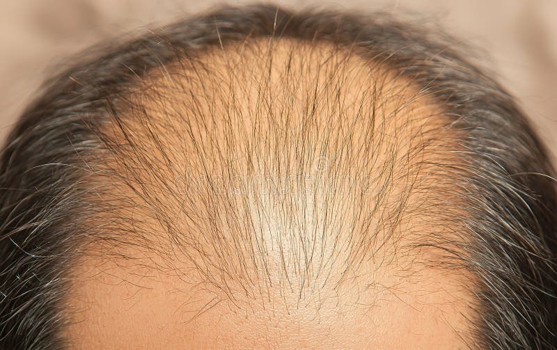 A Close-up View of Male Pattern Baldness Showcasing Thinning Hair on ...