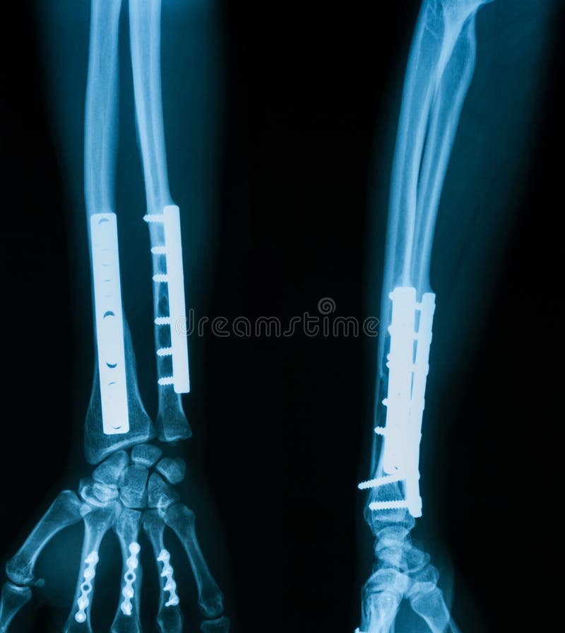 Image De Rayon X De Fémur Cassé Photo stock - Image du diagnostic ...