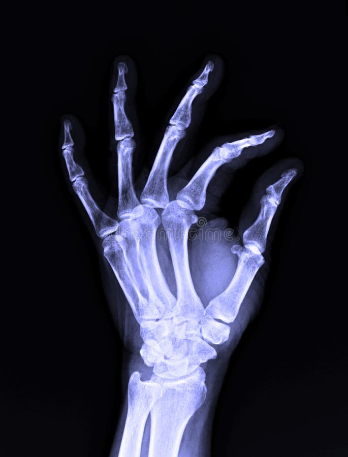 Image De Rayon X De La Main Gauche Humaine Masculine Photo stock ...